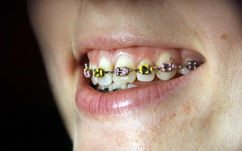 Ir kreivi dantys gali virsti holivudine šypsena | Šiaulių kraštas