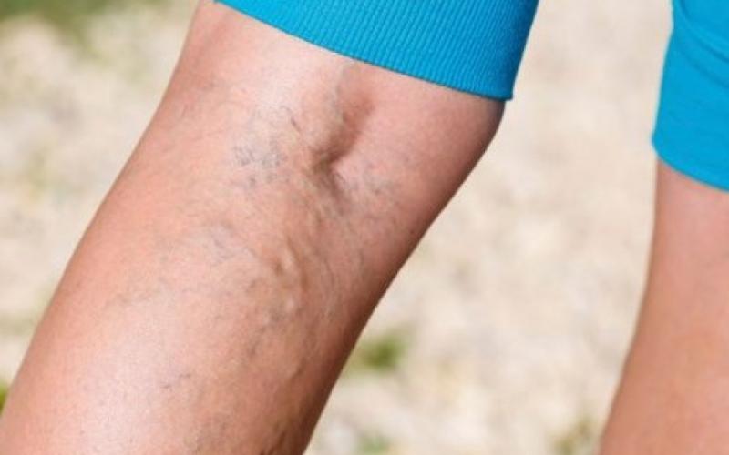 Ar venų operacija yra tinkamas sprendimas? | Šiaulių kraštas